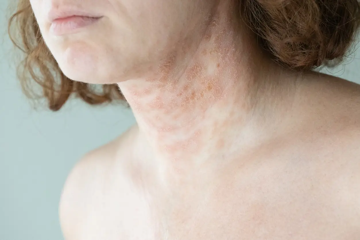 Was ist ein Ekzem – und was hilft dagegen? | CeraVe
