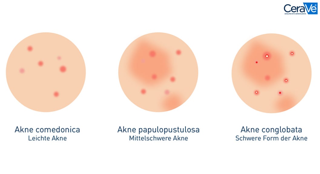 Alles, was du über Akne wissen musst | CeraVe Germany